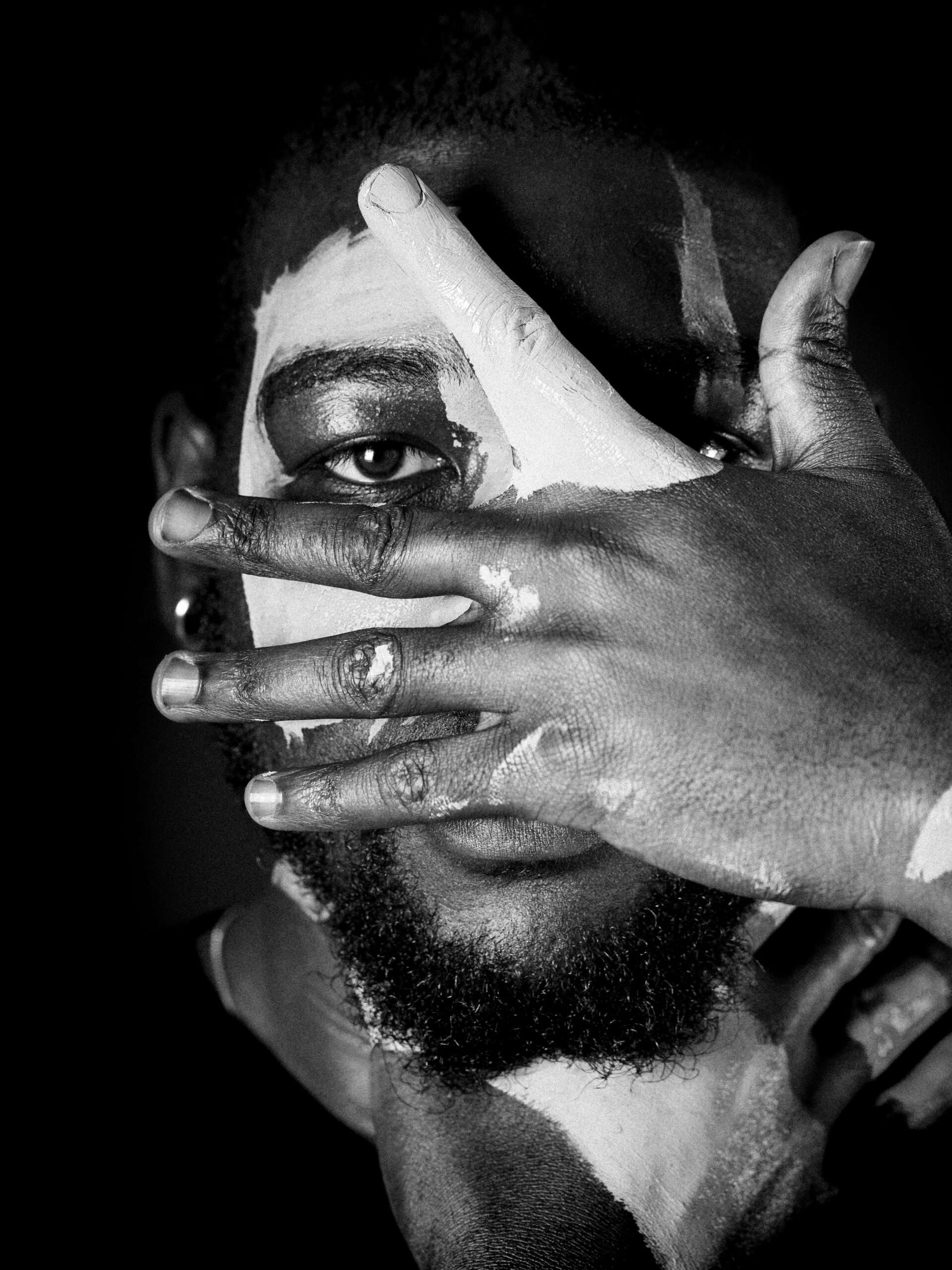 Scars on dark skin: Not All “Scars” Are Scars - Find A Black Doctor
