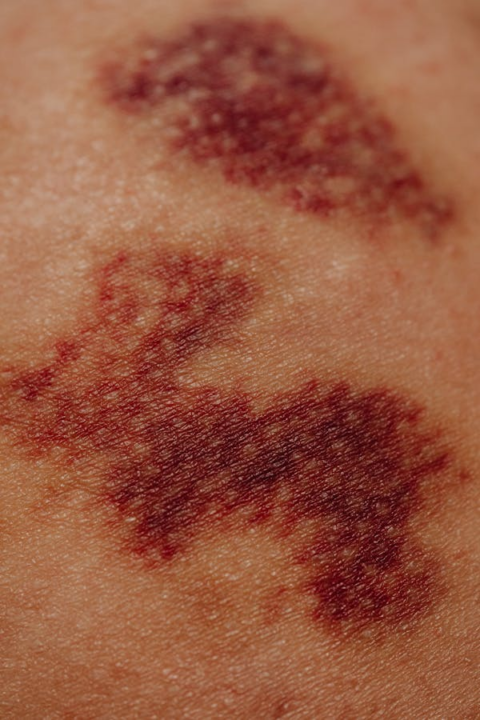Caring for Bruises on Black Skin - Find A Black Doctor
