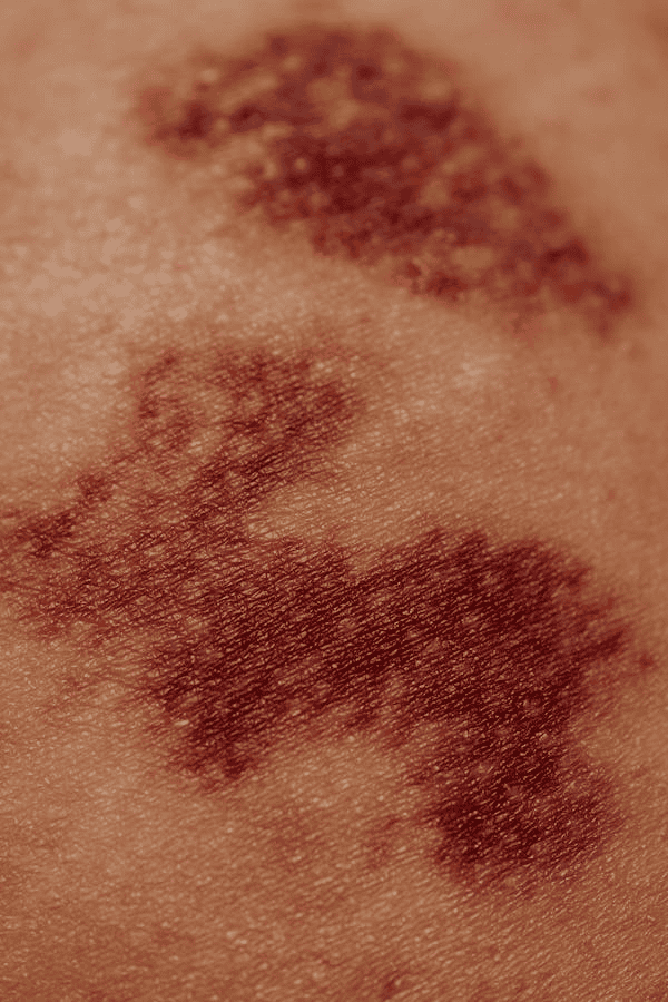 Caring for Bruises on Black Skin - Find A Black Doctor